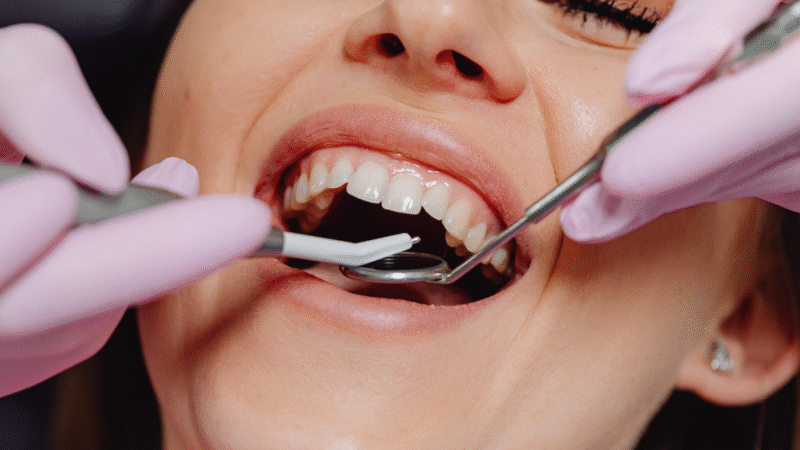 How to Care for Your Teeth After a Filling | Maple Hill Dentistry