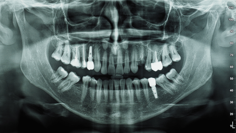 The Truth About Root Canals: What to Expect and Why They’re Safe ...